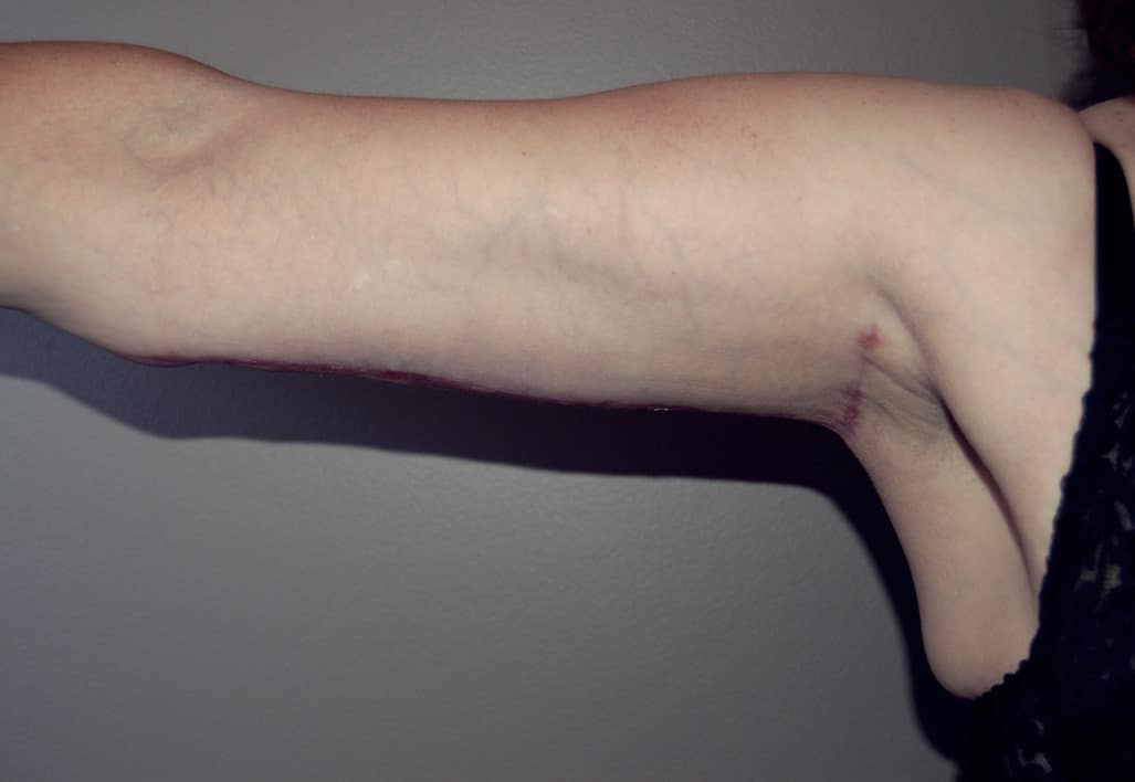 What Happens to Arm Liposuction Scars? - Arm Liposuction